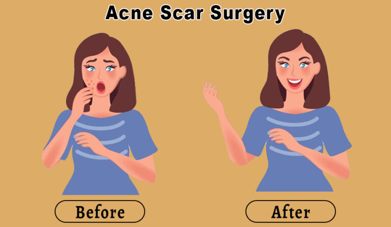 Acne Scar Surgery – PIDAM – The Dermatologist